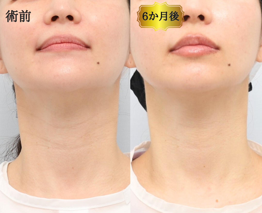 PRPF療法 - 新宿の美容外科・美容皮膚科ならPonoクリニック