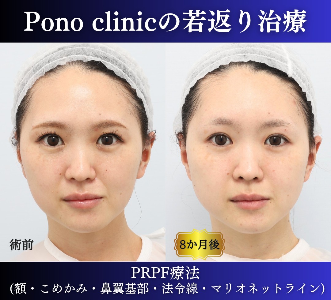 PRPF®療法 - 新宿の美容外科・美容皮膚科ならPonoクリニック