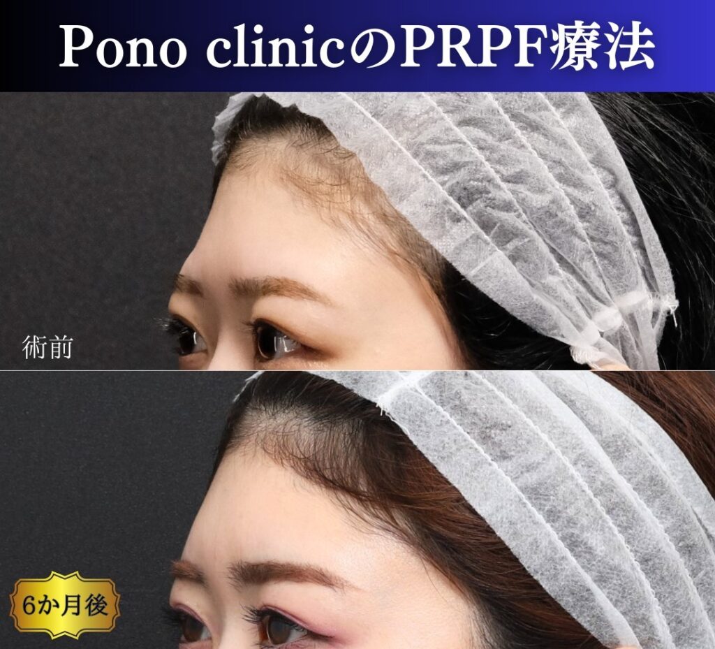 PRPF®療法 - 新宿の美容外科・美容皮膚科ならPonoクリニック