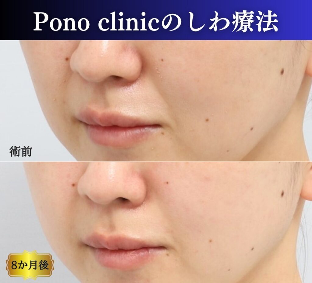 PRPF®療法 - 新宿の美容外科・美容皮膚科ならPonoクリニック