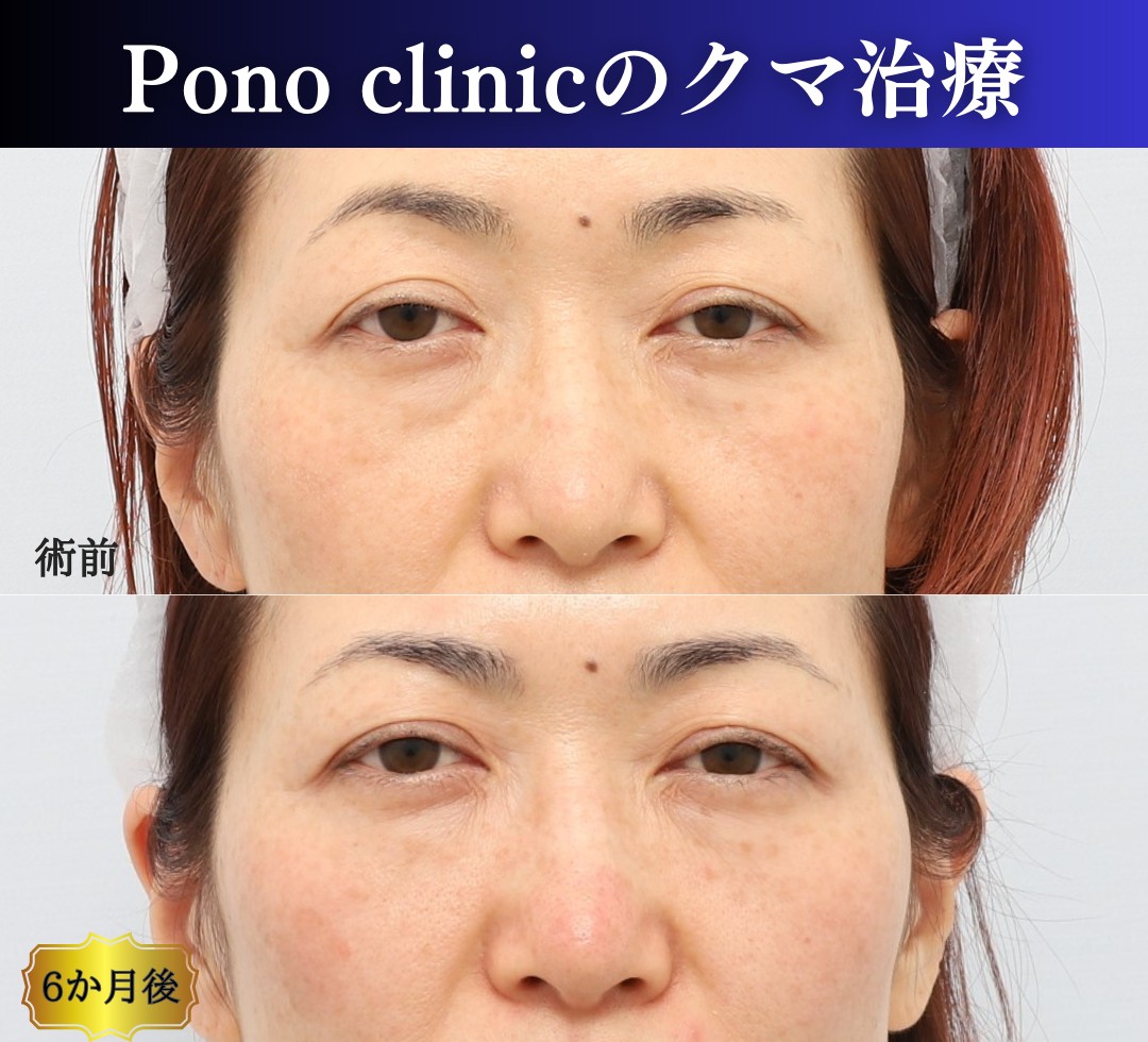 PRPF療法（目の下、ゴルゴライン、法令線）｜No,016 - 新宿の美容外科・美容皮膚科ならPonoクリニック
