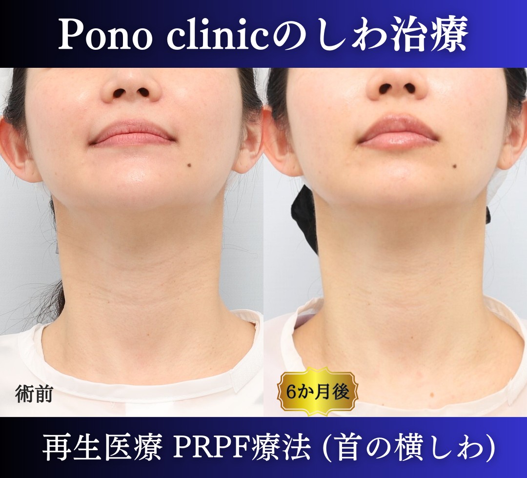 PRPF療法 - 新宿の美容外科・美容皮膚科ならPonoクリニック