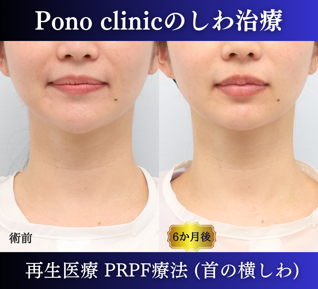 PRPF療法 - 新宿の美容外科・美容皮膚科ならPonoクリニック