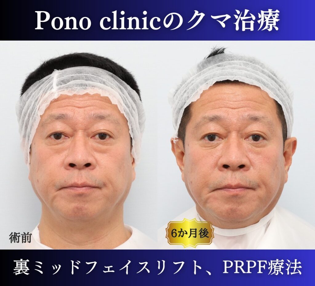 裏ミッドフェイスリフト®、PRPF®療法（目の下）｜No,046 - 新宿の美容外科・美容皮膚科ならPonoクリニック