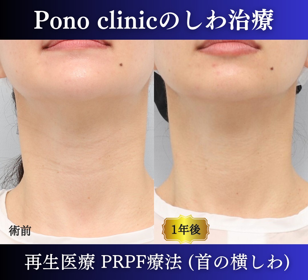PRPF®療法 - 新宿の美容外科・美容皮膚科ならPonoクリニック