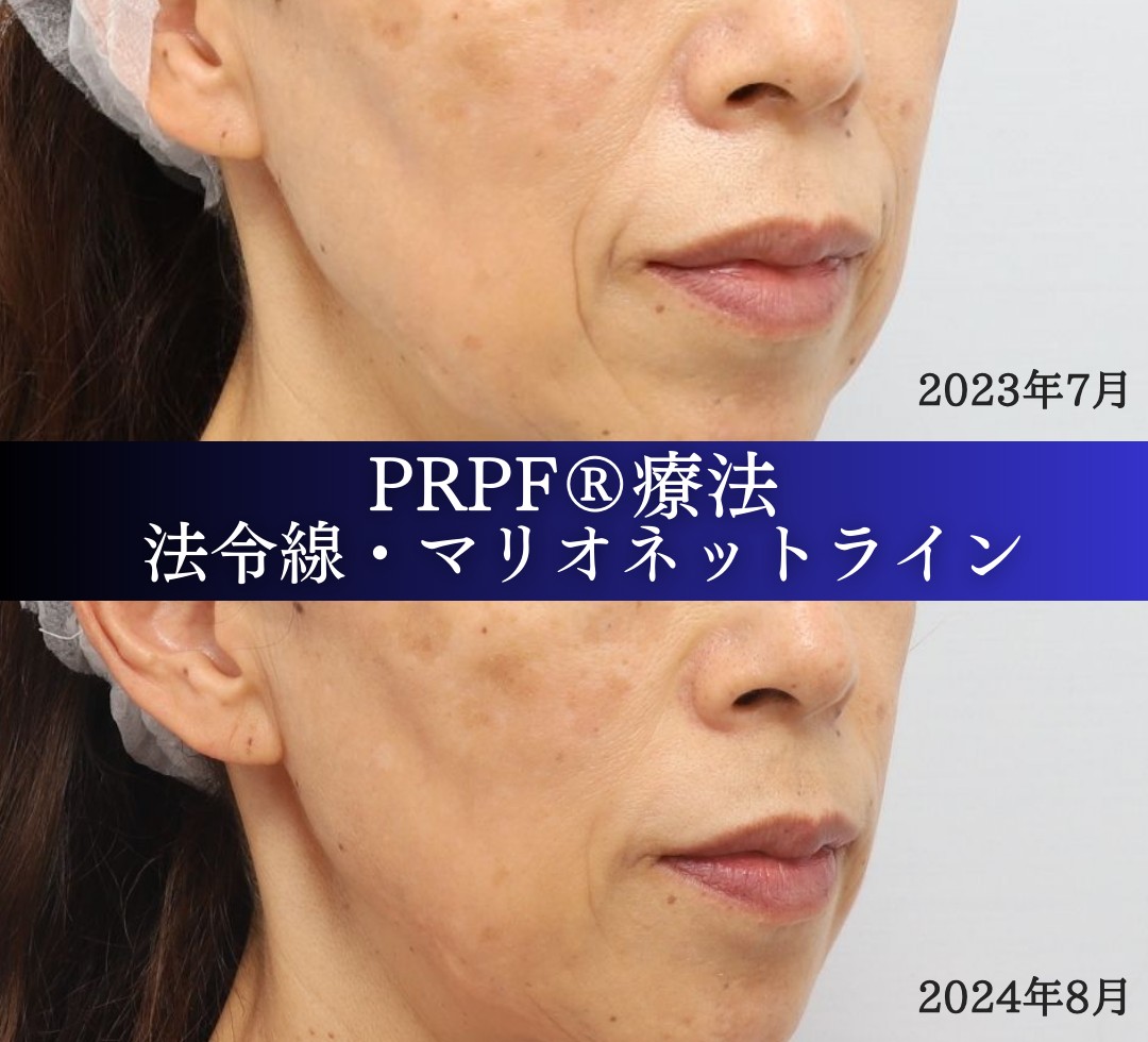 PRPF®療法 目の上｜No,096 - 新宿の美容外科・美容皮膚科ならPonoクリニック