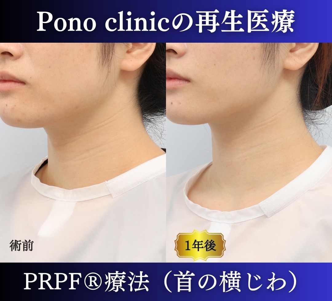 PRPF®療法 - 新宿の美容外科・美容皮膚科ならPonoクリニック