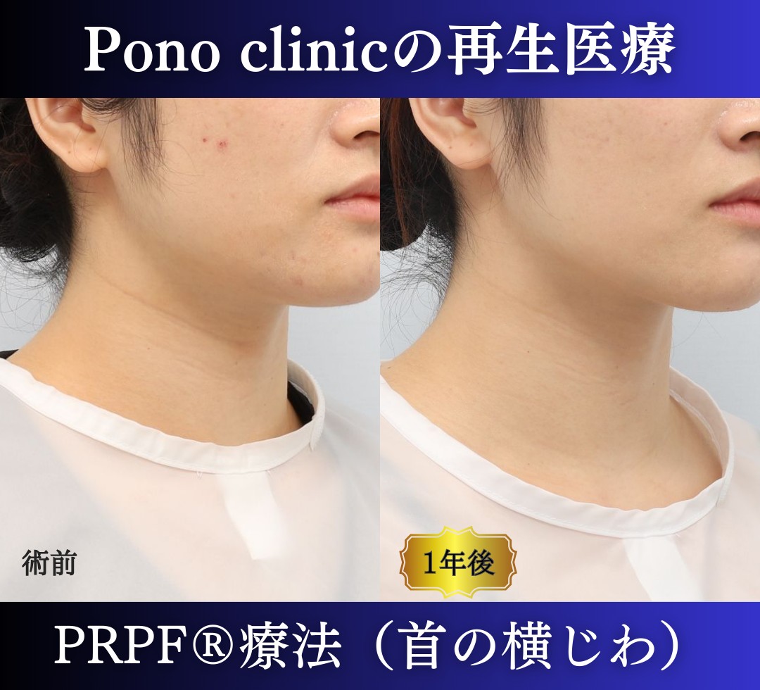 PRPF®療法 - 新宿の美容外科・美容皮膚科ならPonoクリニック