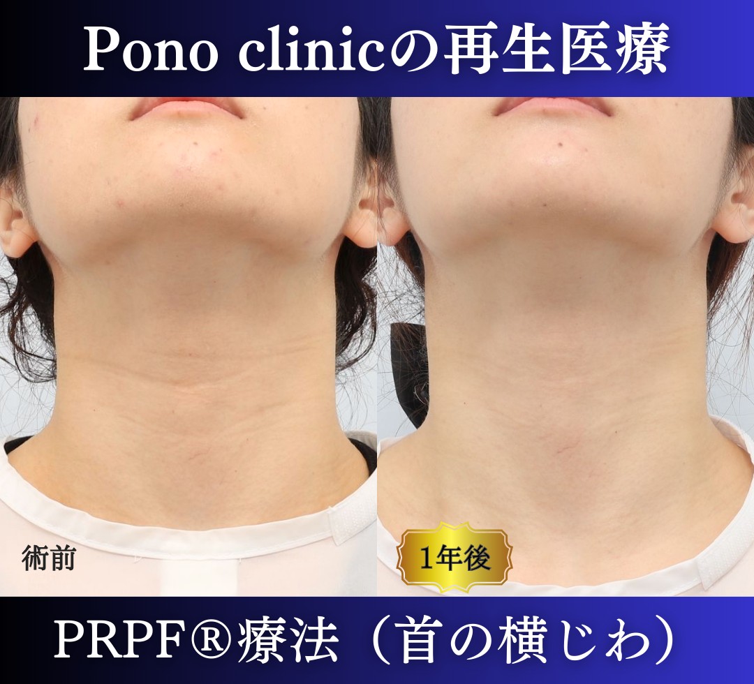 PRPF®療法 - 新宿の美容外科・美容皮膚科ならPonoクリニック