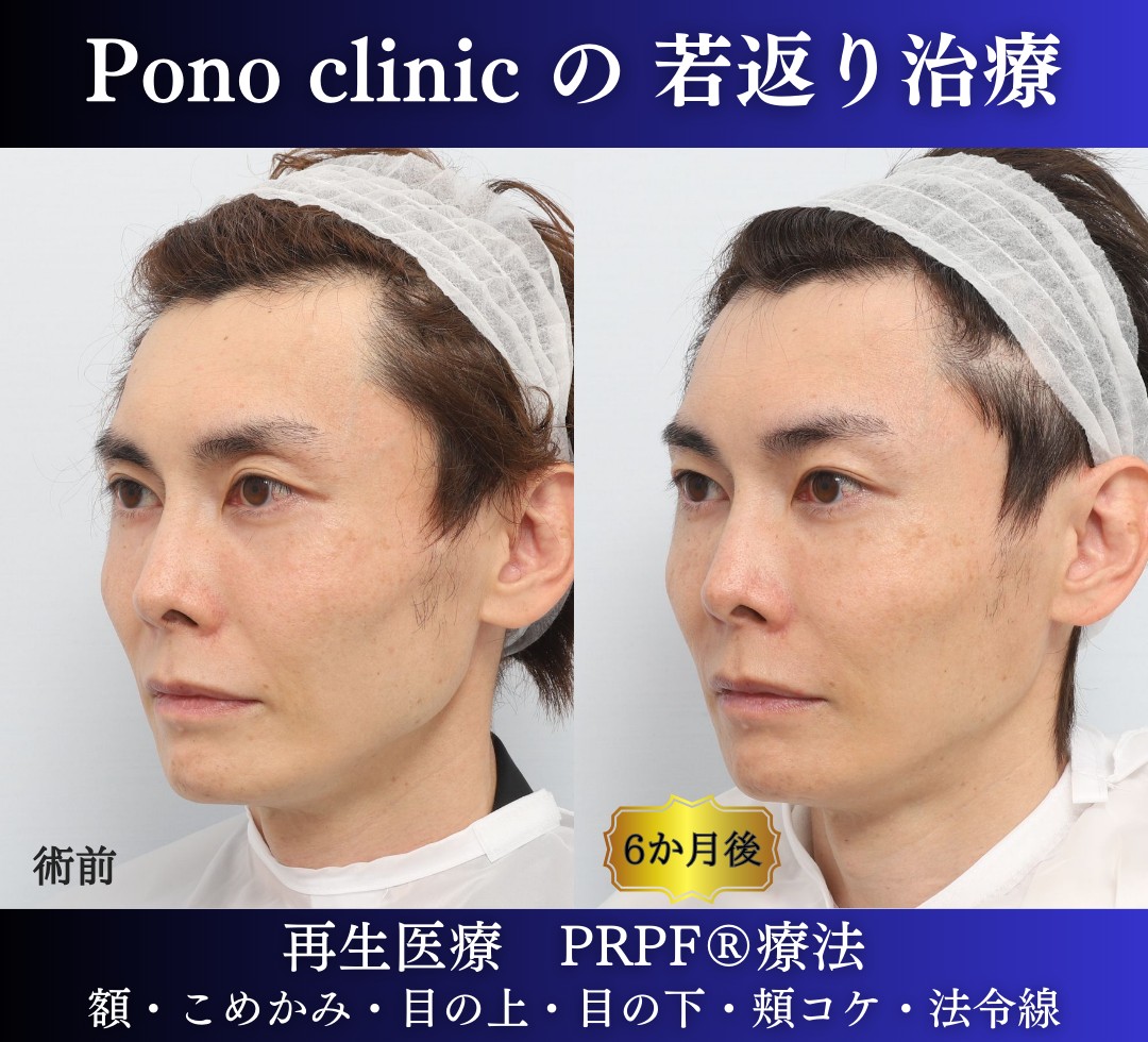 PRPF®療法 - 新宿の美容外科・美容皮膚科ならPonoクリニック