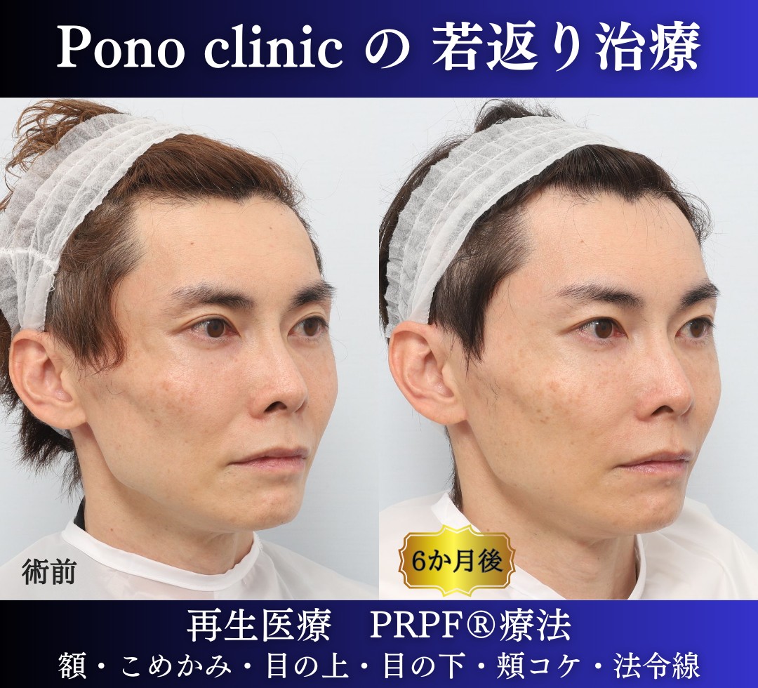 PRPF®療法 - 新宿の美容外科・美容皮膚科ならPonoクリニック